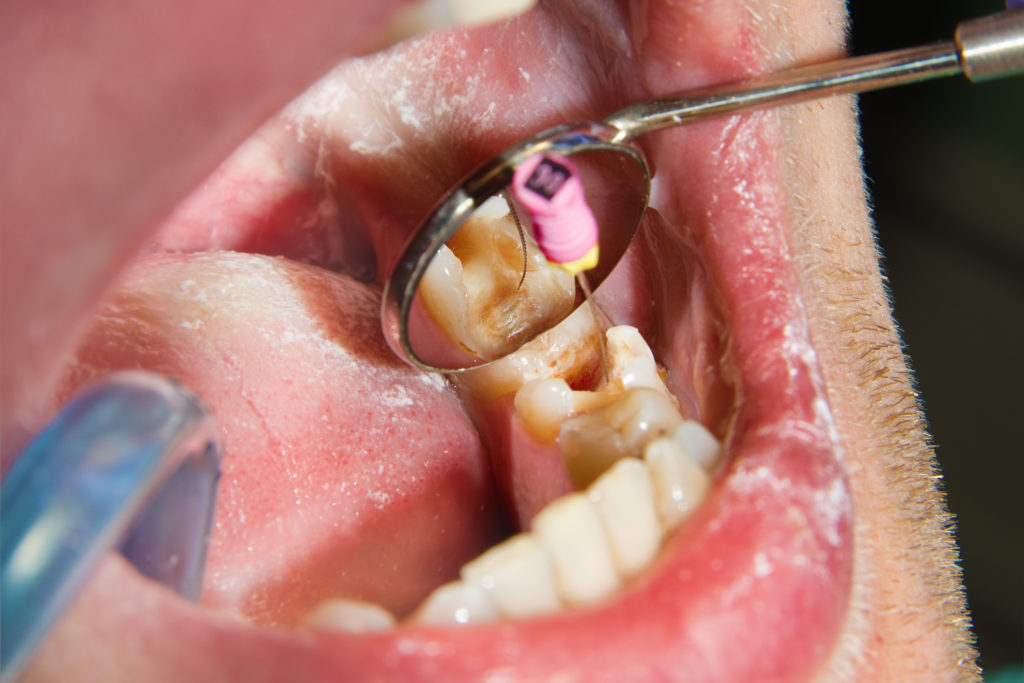 Root Canal Bismarck ND Root Canal Therapy Garrison ND Endodontics
